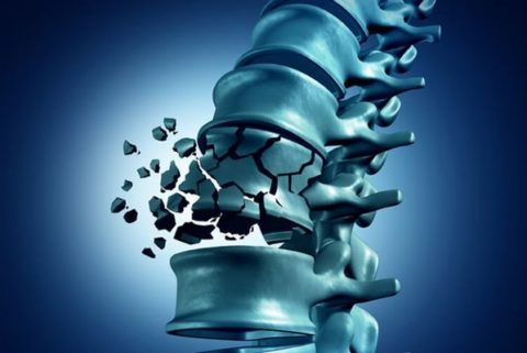Fracture - Tassement vertébral - Institut du rachis Paris